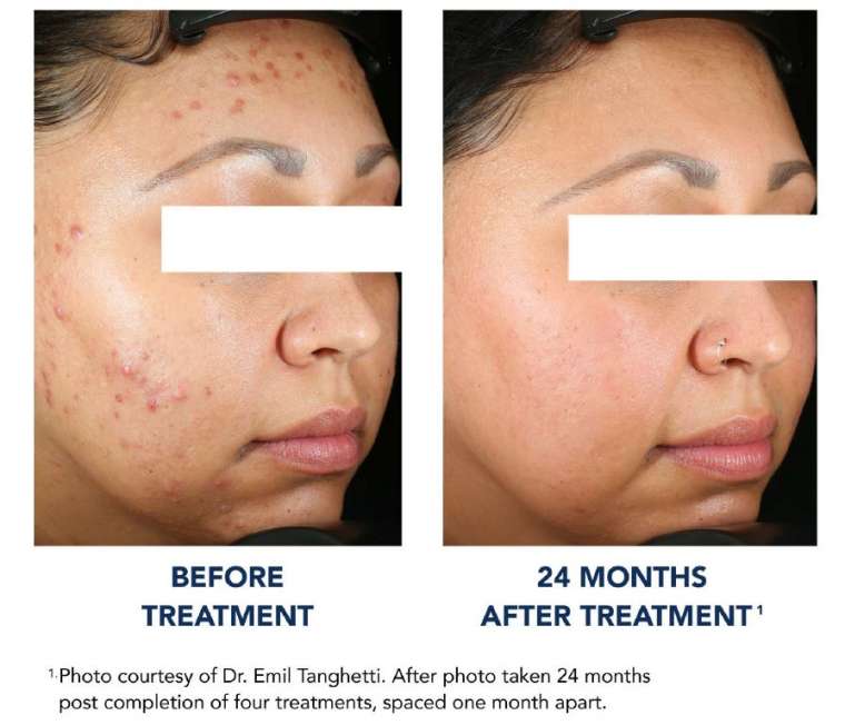 Accure Laser System for Acne – Inspira Dermatology – Dermatology Clinic