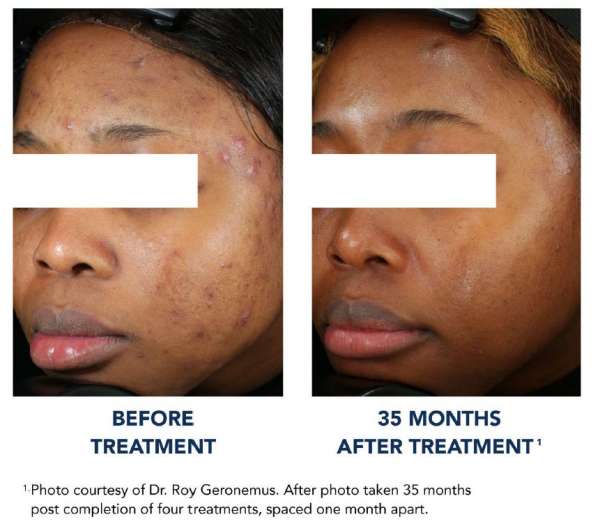 Accure Laser System for Acne – Inspira Dermatology – Dermatology Clinic