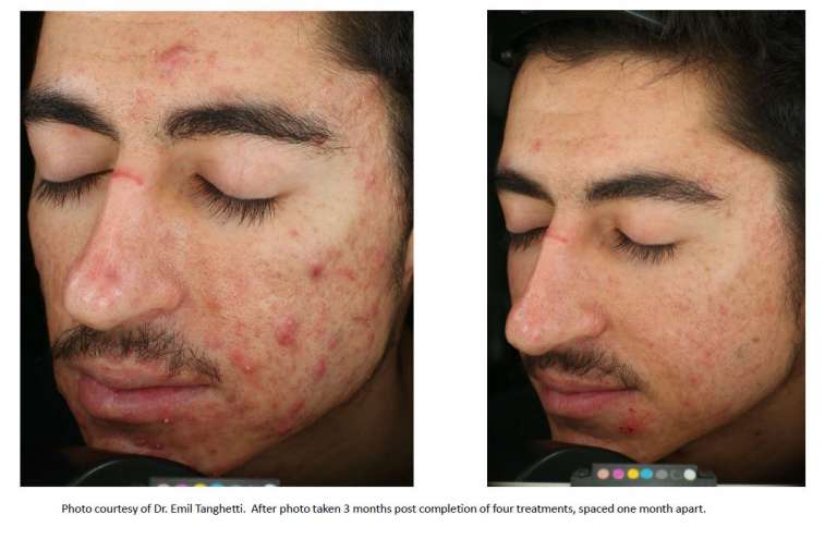 Accure Laser System for Acne – Inspira Dermatology – Dermatology Clinic