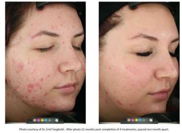 Accure Laser System for Acne – Inspira Dermatology – Dermatology Clinic