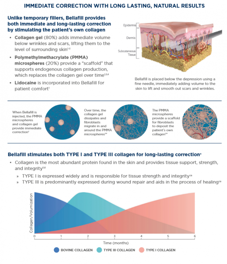 Bellafill – Inspira Dermatology – Dermatology Clinic