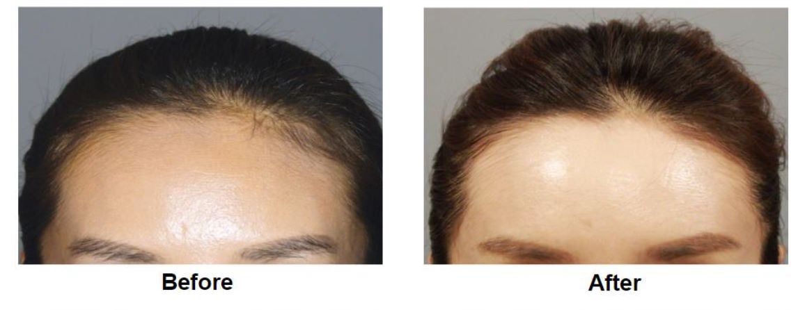 Air Shine – Inspira Dermatology – Dermatology Clinic